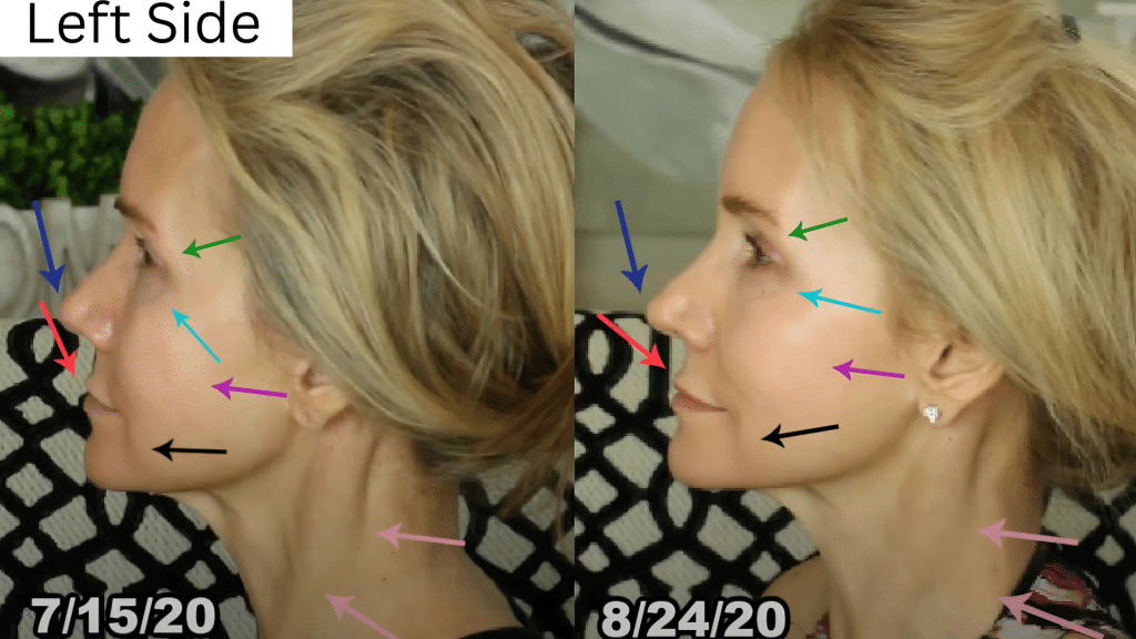 Face Yoga Before And After: Real Results Explained - My Fitness Yoga